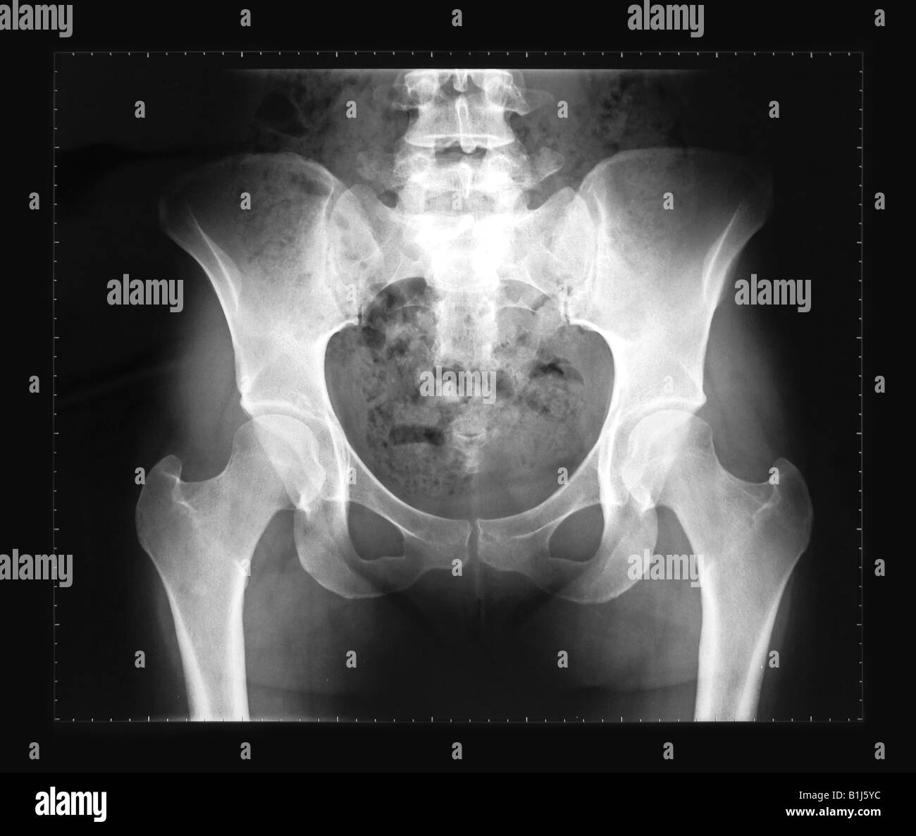 X-ray of the spinal column and pelvis of a woman Stock Photo - Alamy