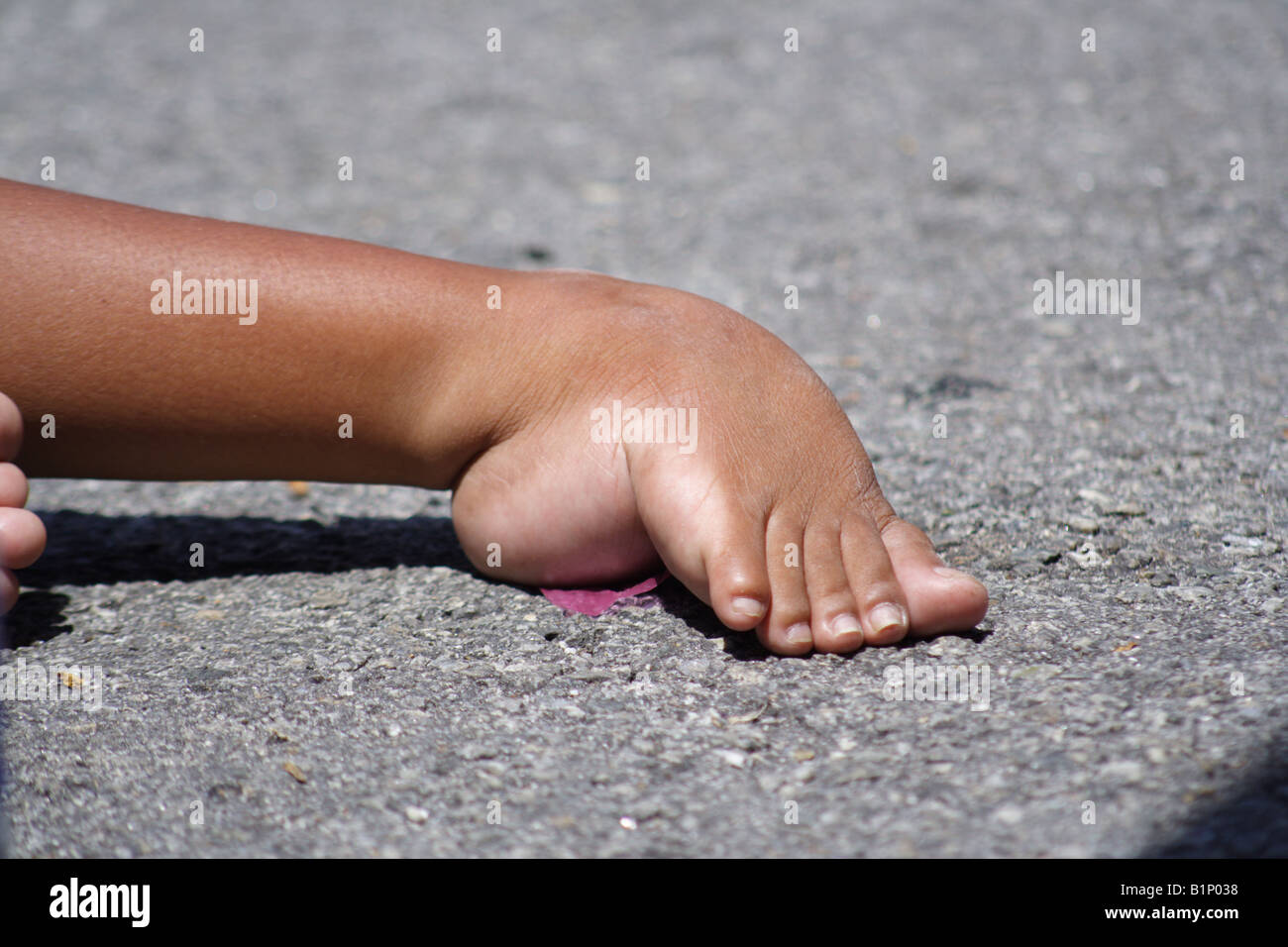 Deformed leg hi-res stock photography and images - Alamy