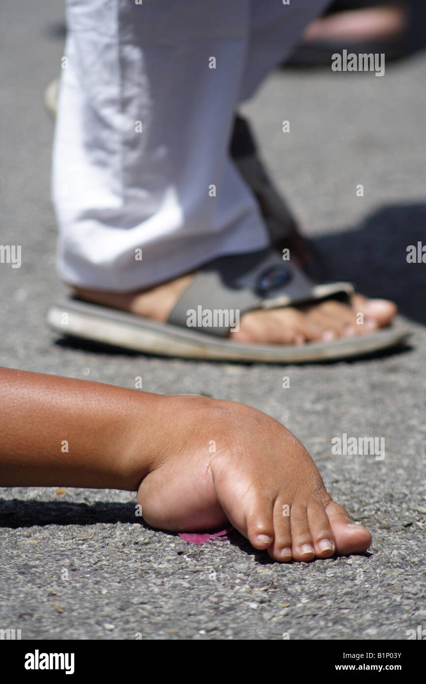 Deformed leg and pedestrian walking by Stock Photo - Alamy