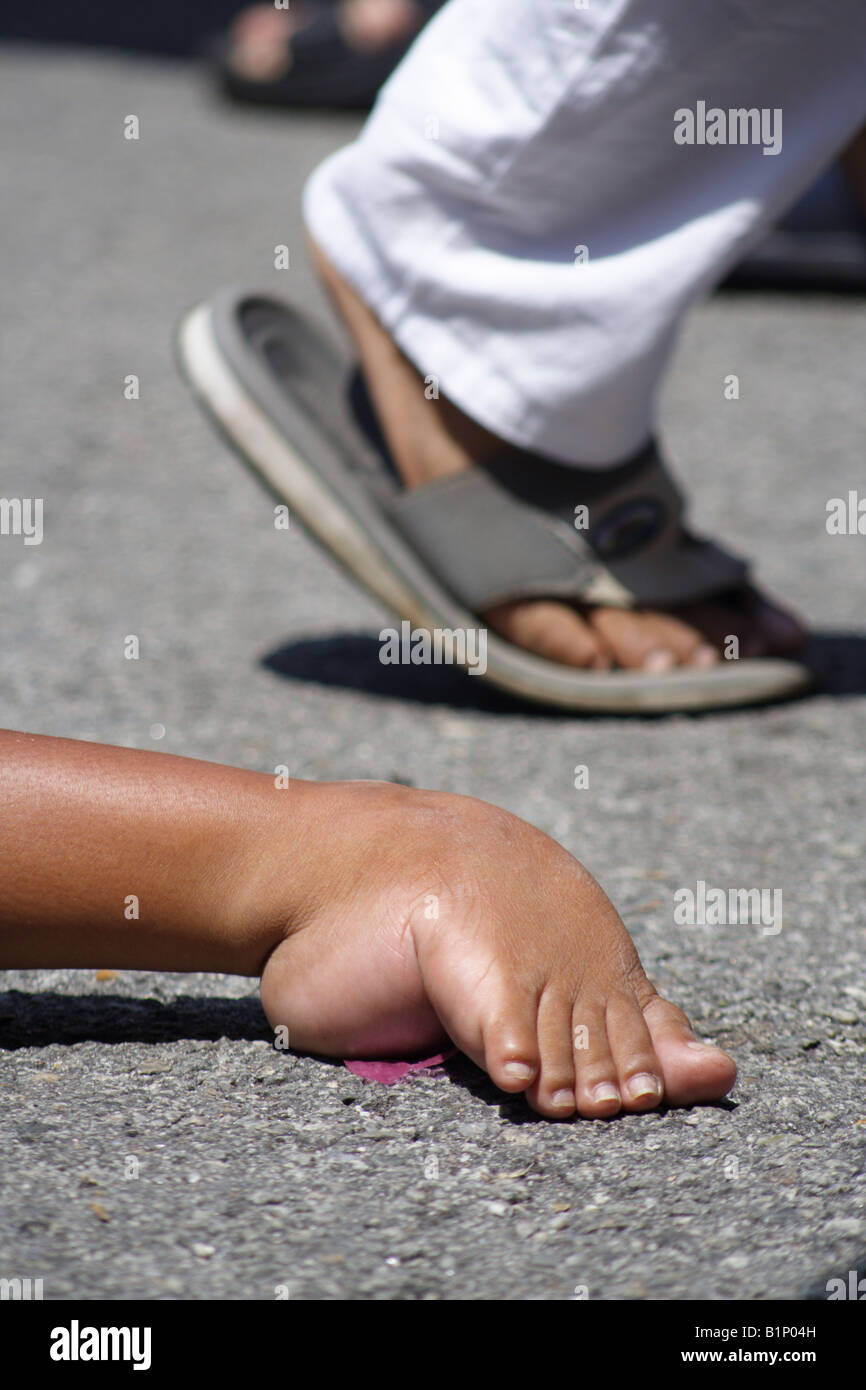 Deformed leg hi-res stock photography and images - Alamy