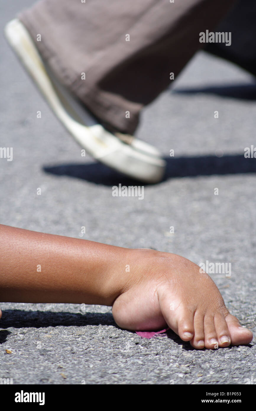 Deformed leg hi-res stock photography and images - Alamy