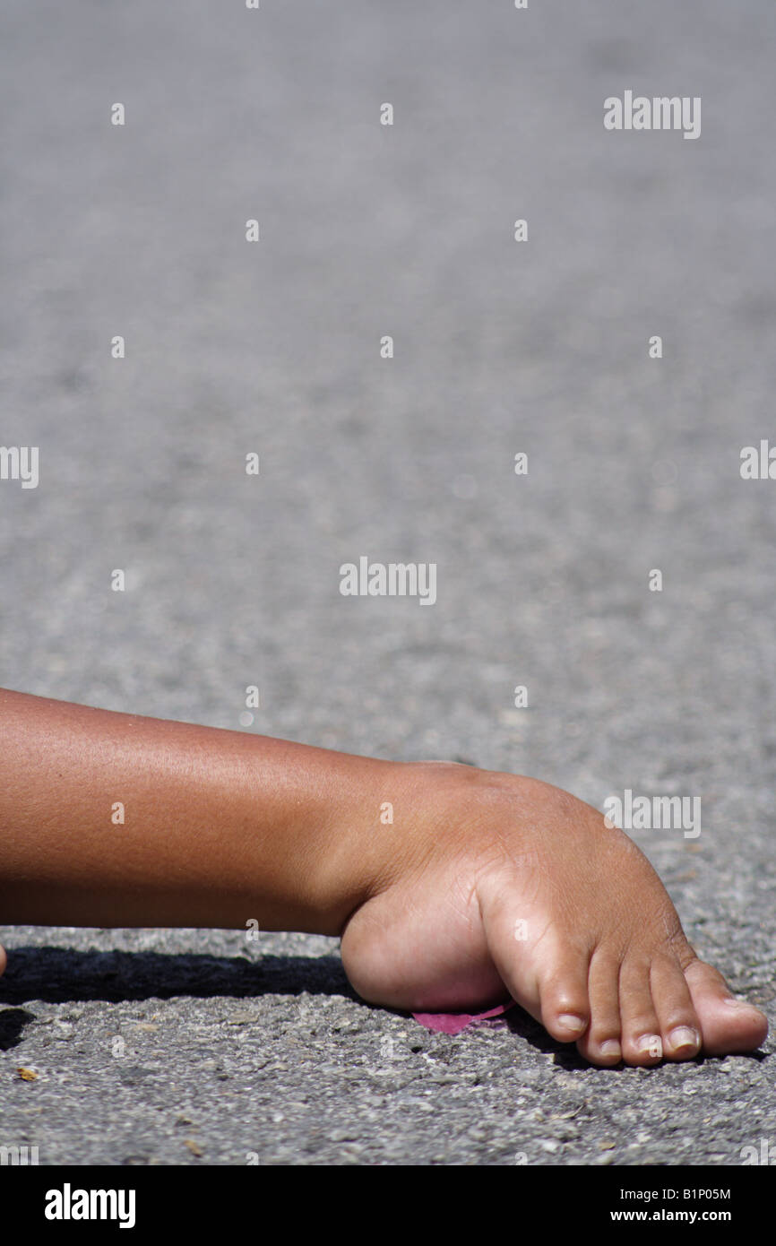 Deformed leg hi-res stock photography and images - Alamy