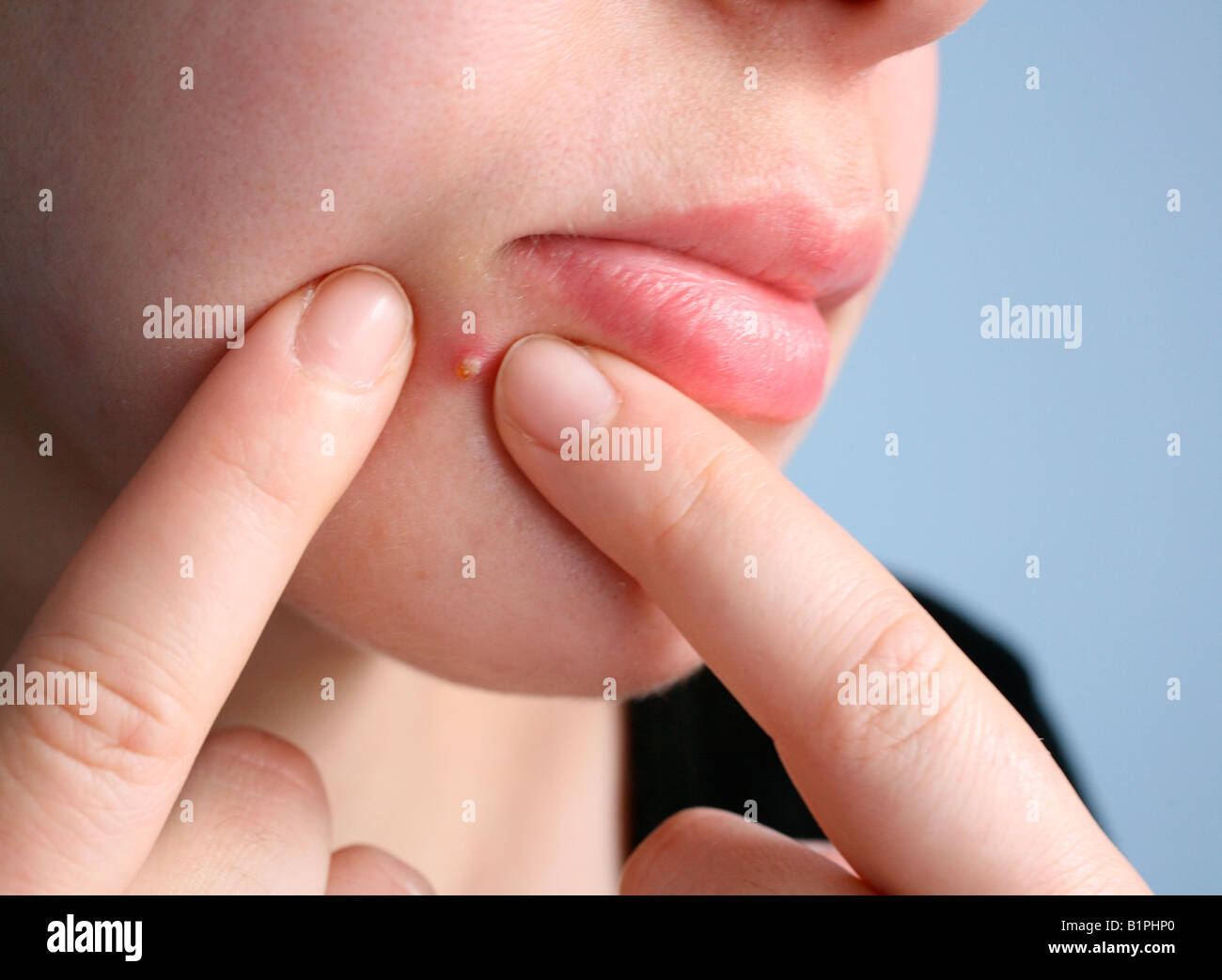 Young woman squeezing a pimple Stock Photo - Alamy