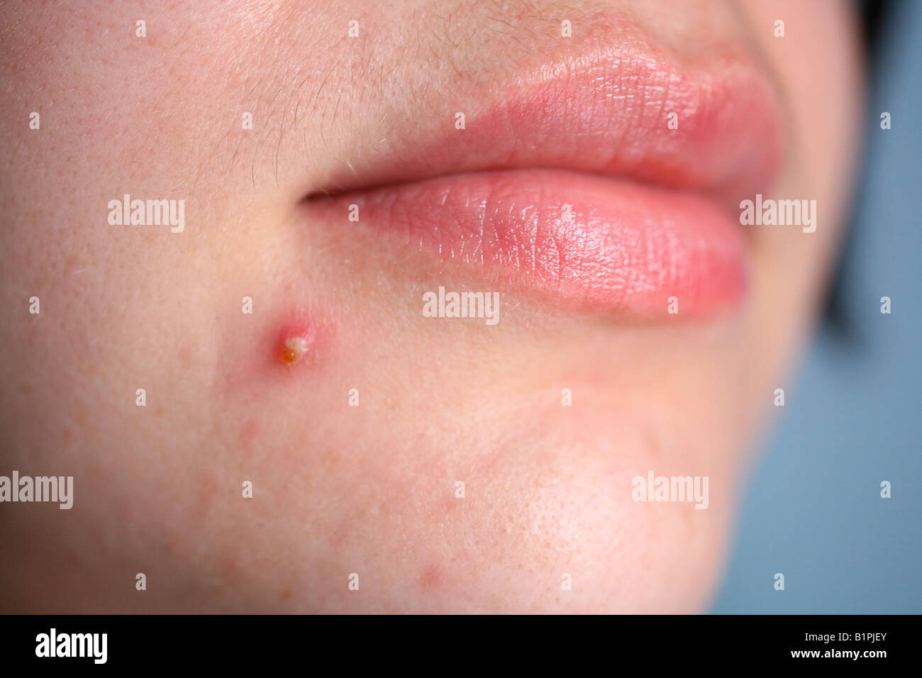 Young woman with a large white spot Stock Photo - Alamy