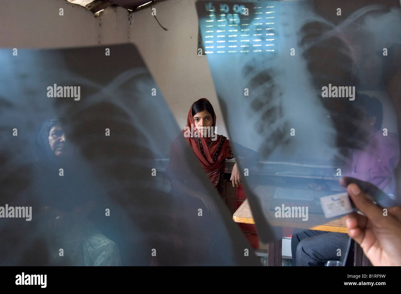 Girl, tuberculosis patient cured after six-month treatment, follow-up ...