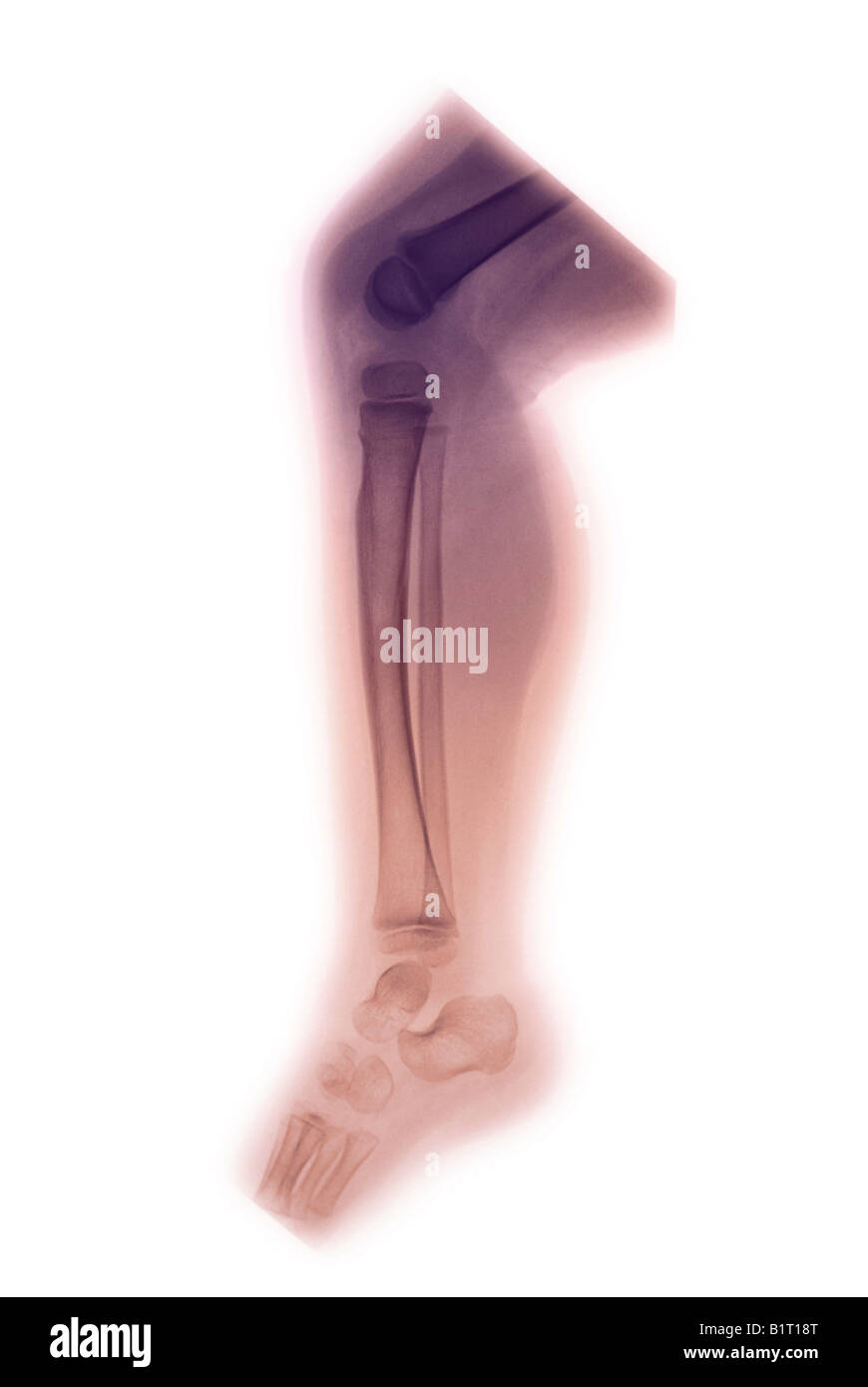 Normal knee x ray hi-res stock photography and images - Alamy