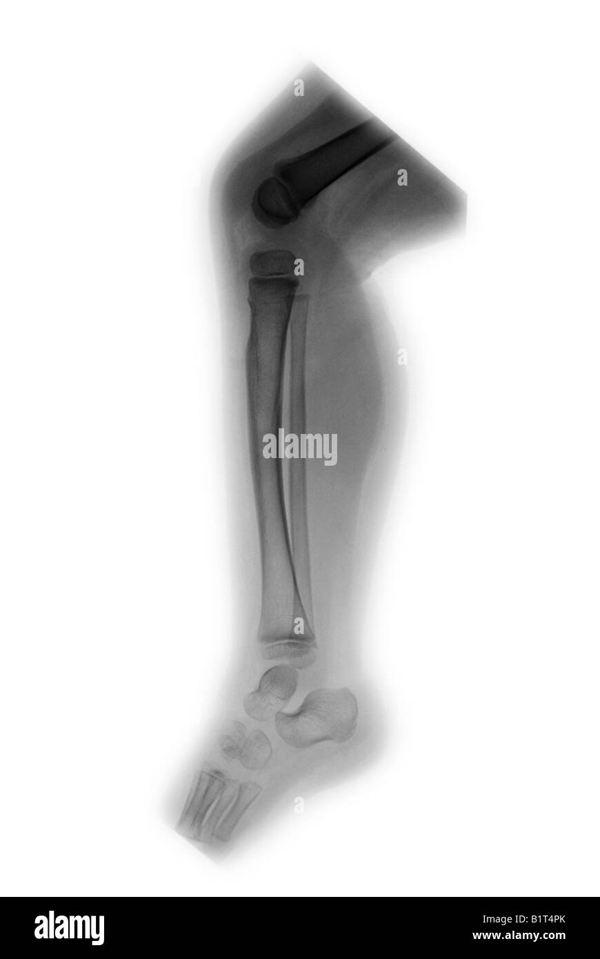 Normal knee x ray hi-res stock photography and images - Alamy