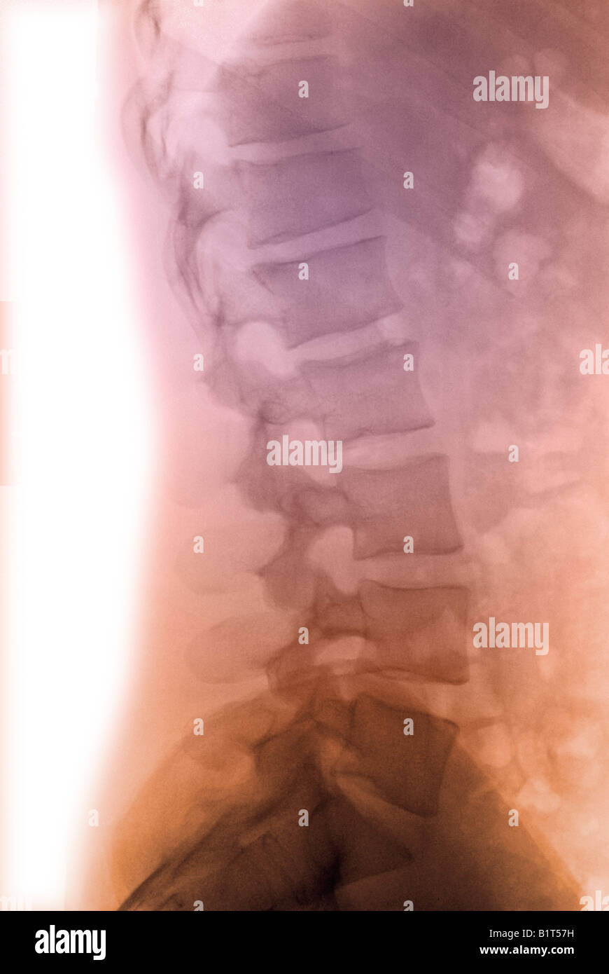 X ray normal lumbar spine hi-res stock photography and images - Alamy