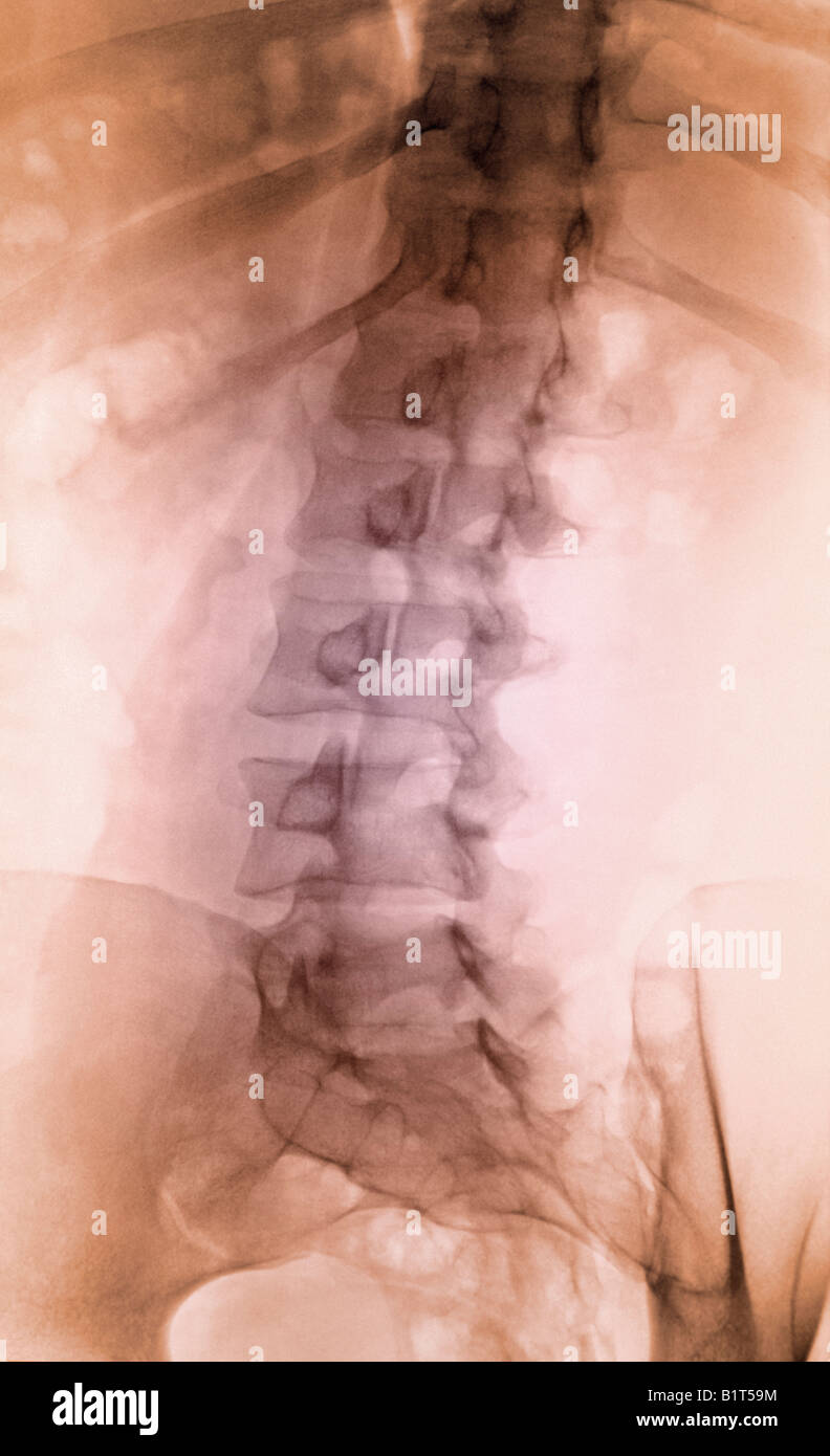 X ray normal lumbar spine hi-res stock photography and images - Alamy
