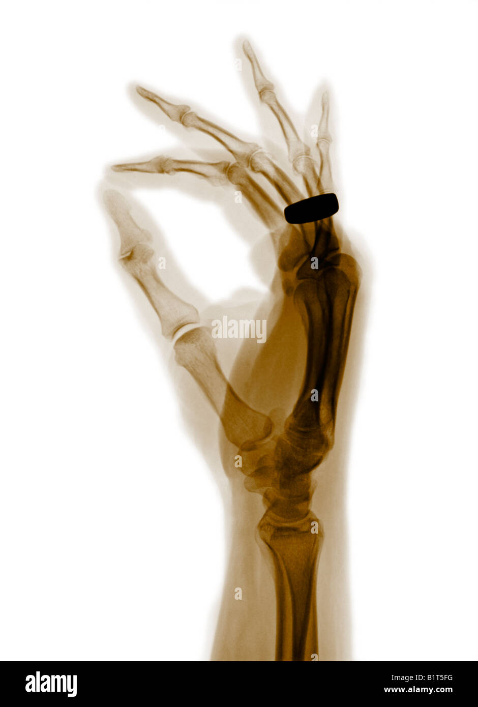 Hand x ray ring hi-res stock photography and images - Alamy