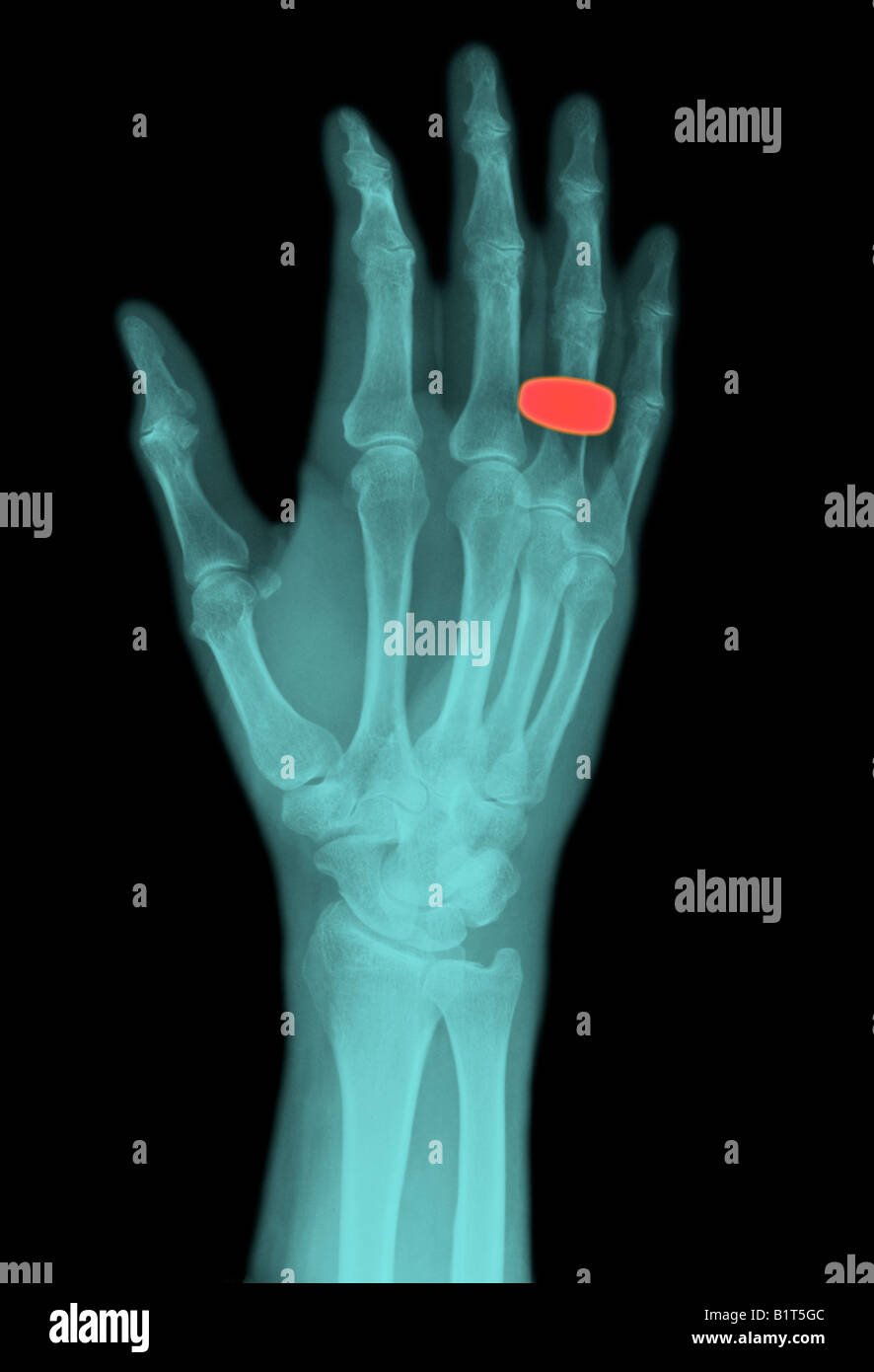 Hand x ray ring hi-res stock photography and images - Alamy