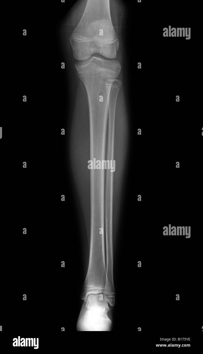 Normal Knee X Ray Stock Photos & Normal Knee X Ray Stock Images - Alamy