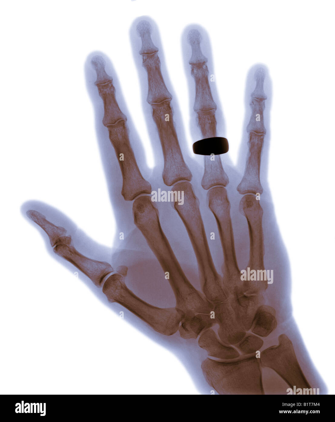 Hand x ray ring hi-res stock photography and images - Alamy