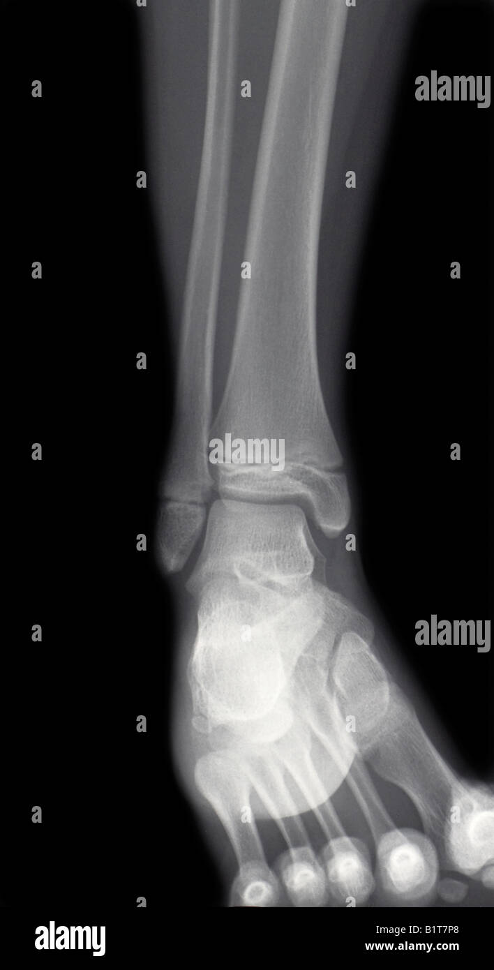 X-ray of 12 year old boy's ankle Stock Photo - Alamy