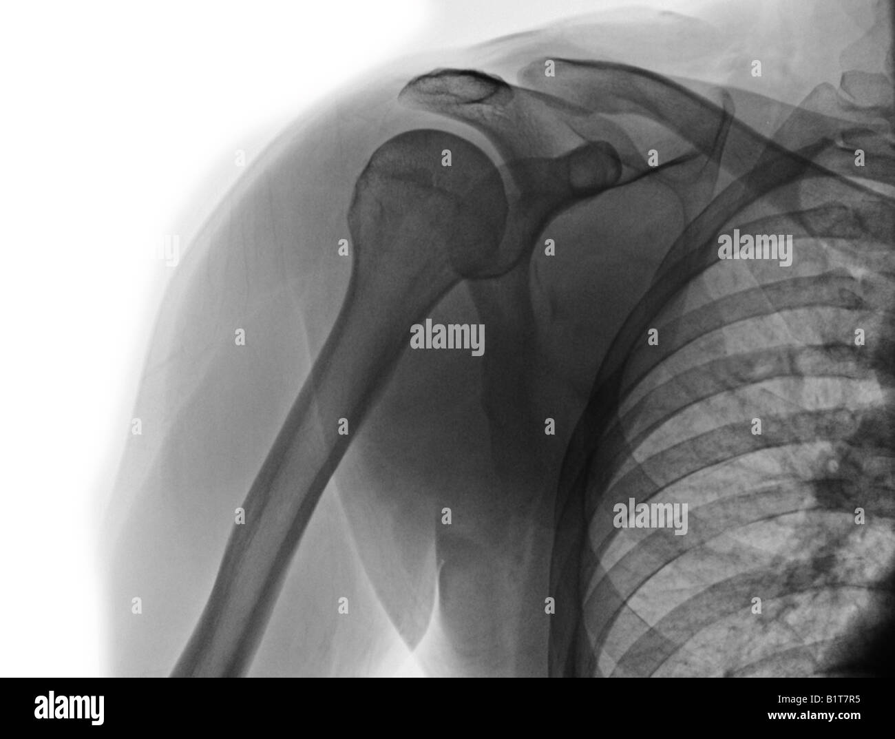 Normal shoulder x ray hi-res stock photography and images - Alamy