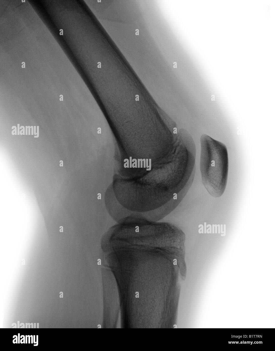 Normal knee x ray hi-res stock photography and images - Alamy