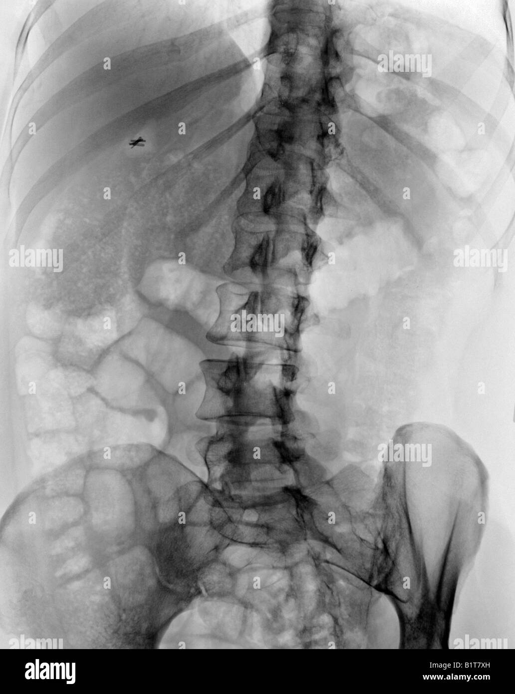 X ray normal lumbar spine hi-res stock photography and images - Alamy