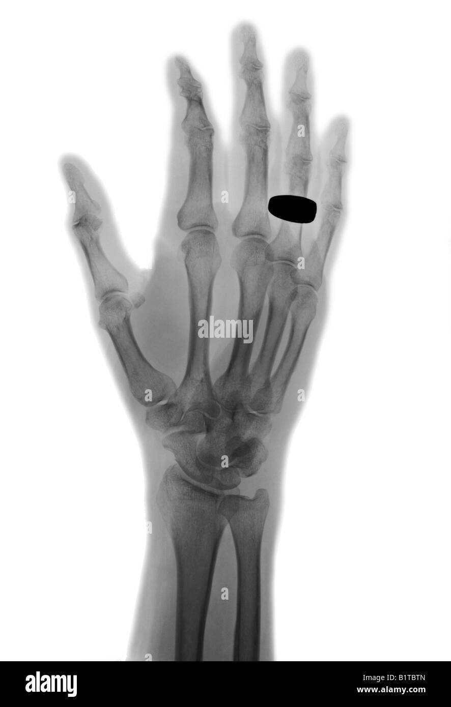 Hand x ray ring hi-res stock photography and images - Alamy