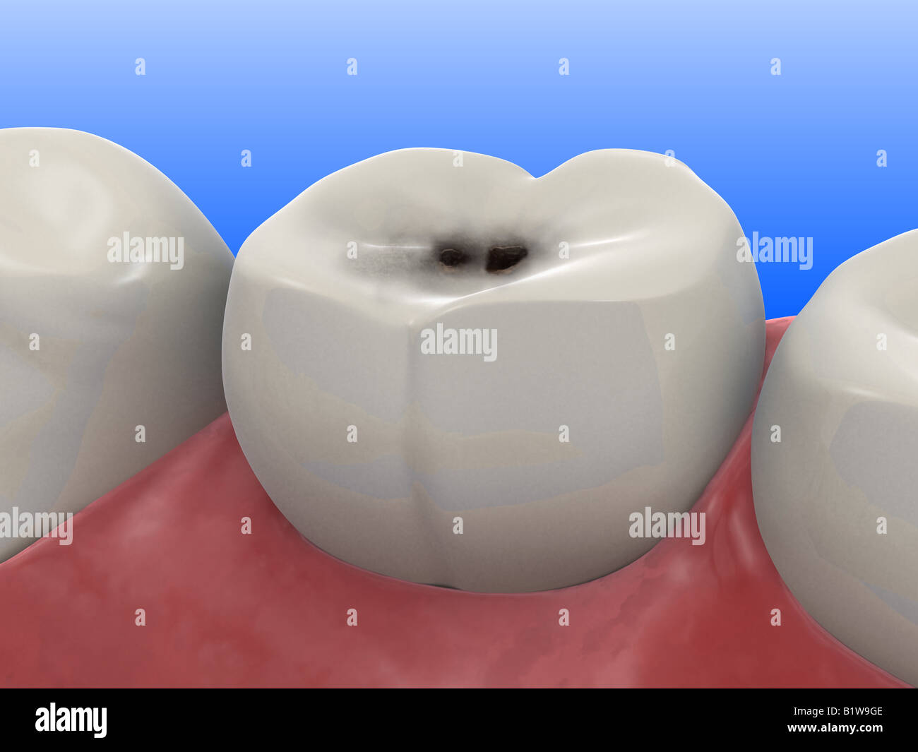 Caries tooth hi-res stock photography and images - Alamy