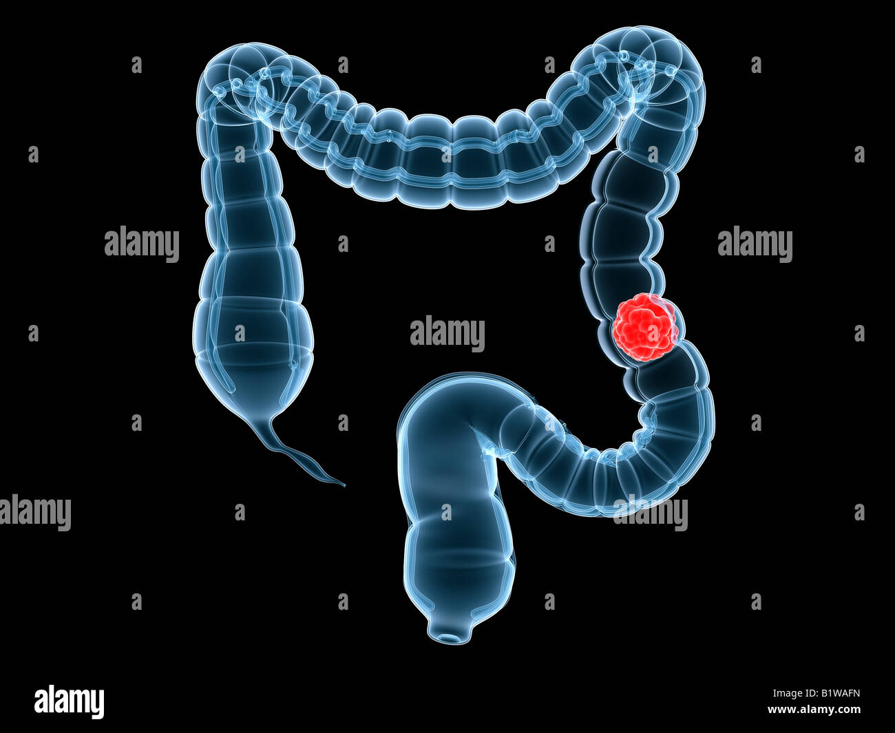 Cancer colon hi-res stock photography and images - Alamy