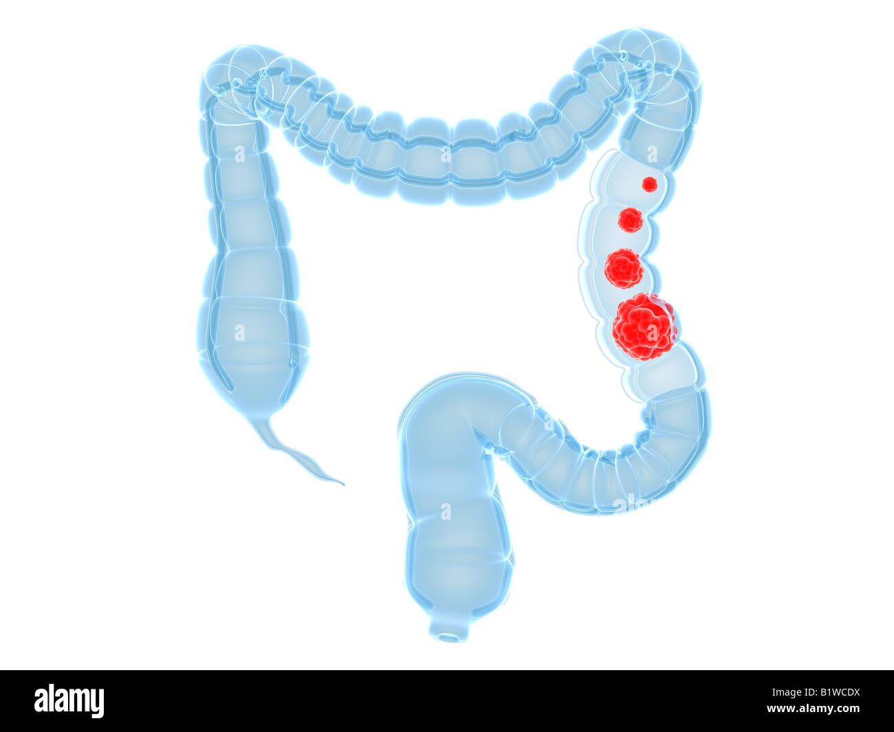 Human colon cancer hi-res stock photography and images - Alamy