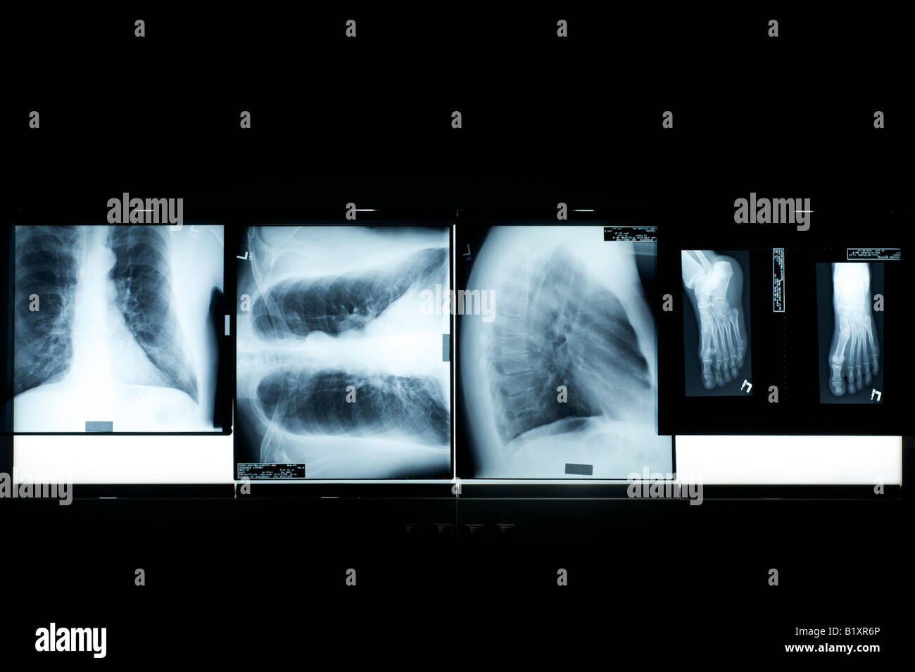 Xray on examination light table Stock Photo - Alamy