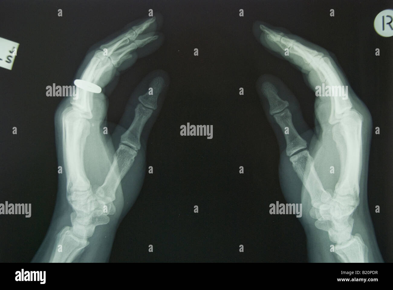 Hand x ray ring hi-res stock photography and images - Alamy
