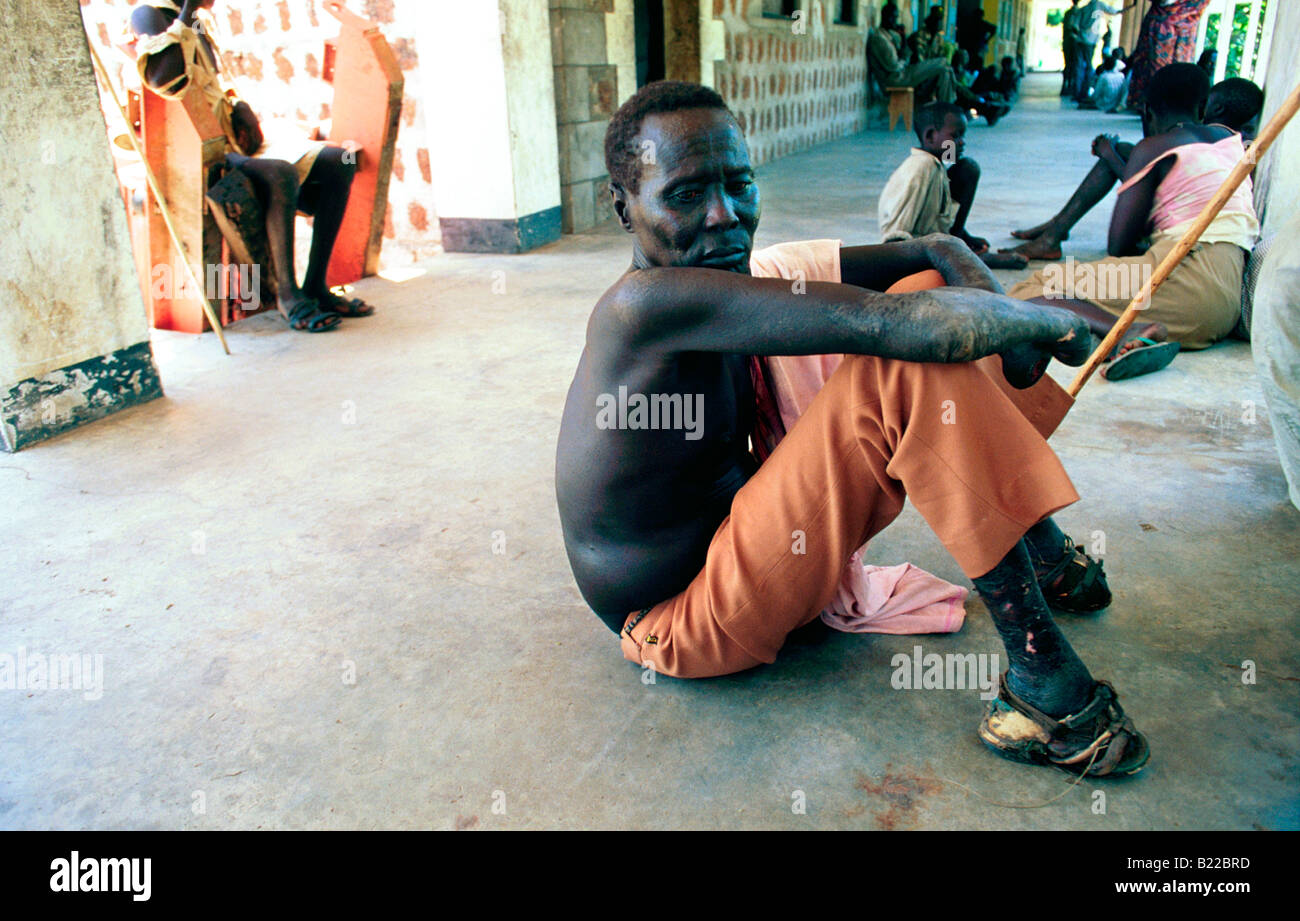 Man with Leprosy in South Sudan, Africa Stock Photo - Alamy