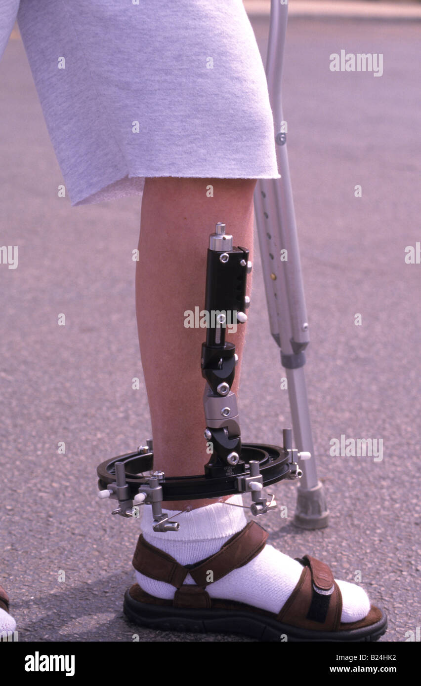 External fixator hi-res stock photography and images - Alamy