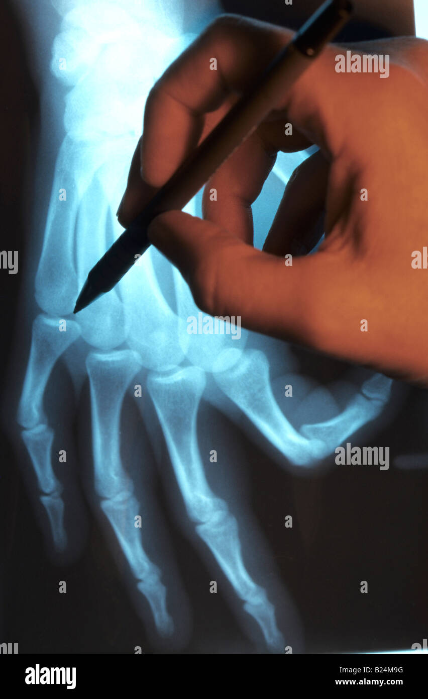 X RAY OF HAND AND HUMAN HAND POINTING TO BONE Stock Photo - Alamy