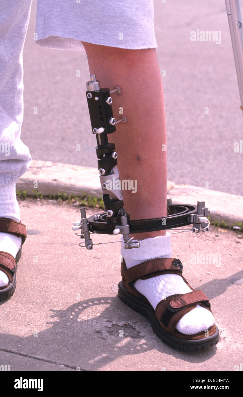 WOMAN'S LEG WITH EXTERNAL FIXATOR Stock Photo - Alamy