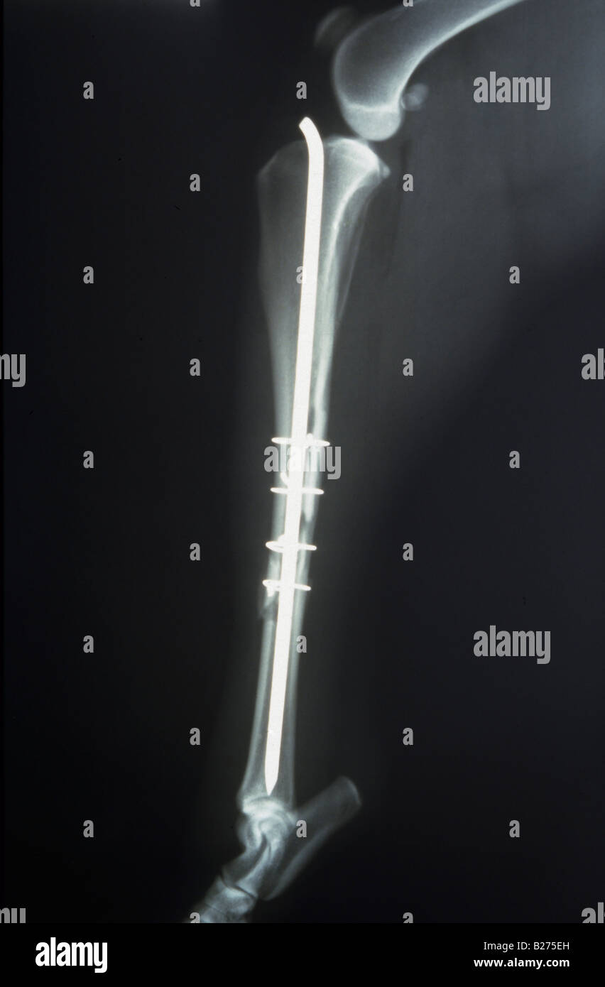 Steel Rods In Legs at Mildred Powell blog