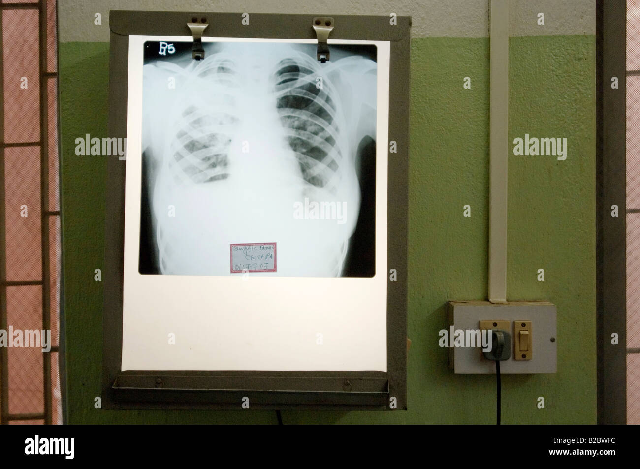 Tb clinic hi-res stock photography and images - Alamy