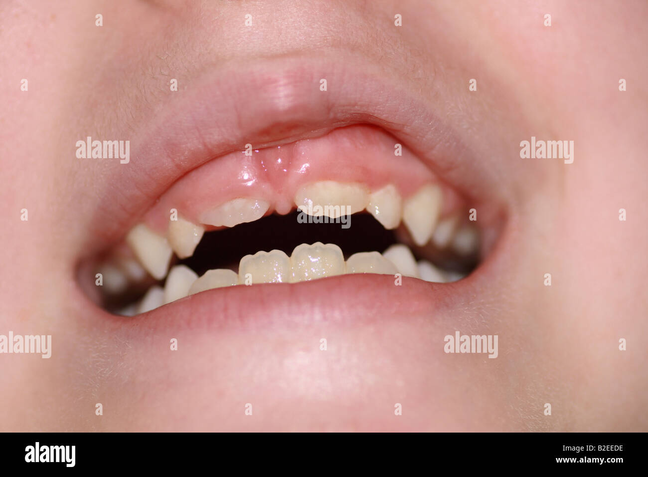 a 7 year old girl's teeth Stock Photo - Alamy