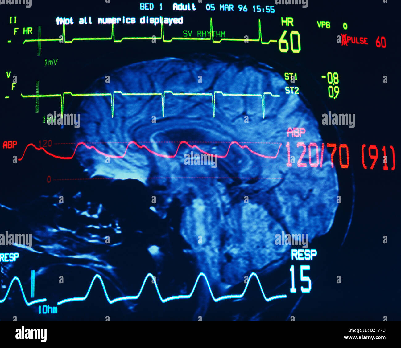 MRI image of a human brain with and EKG chart superimposed Stock Photo ...