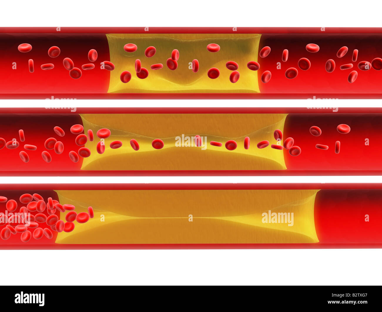 Artery blockage hi-res stock photography and images - Alamy
