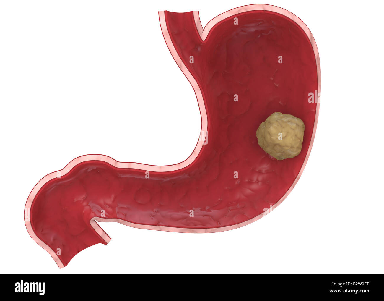 Gastrospasm hi-res stock photography and images - Alamy