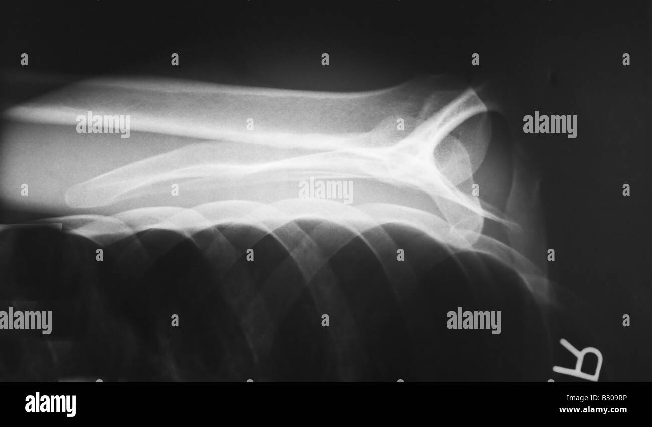 X ray of human shoulder Stock Photo - Alamy