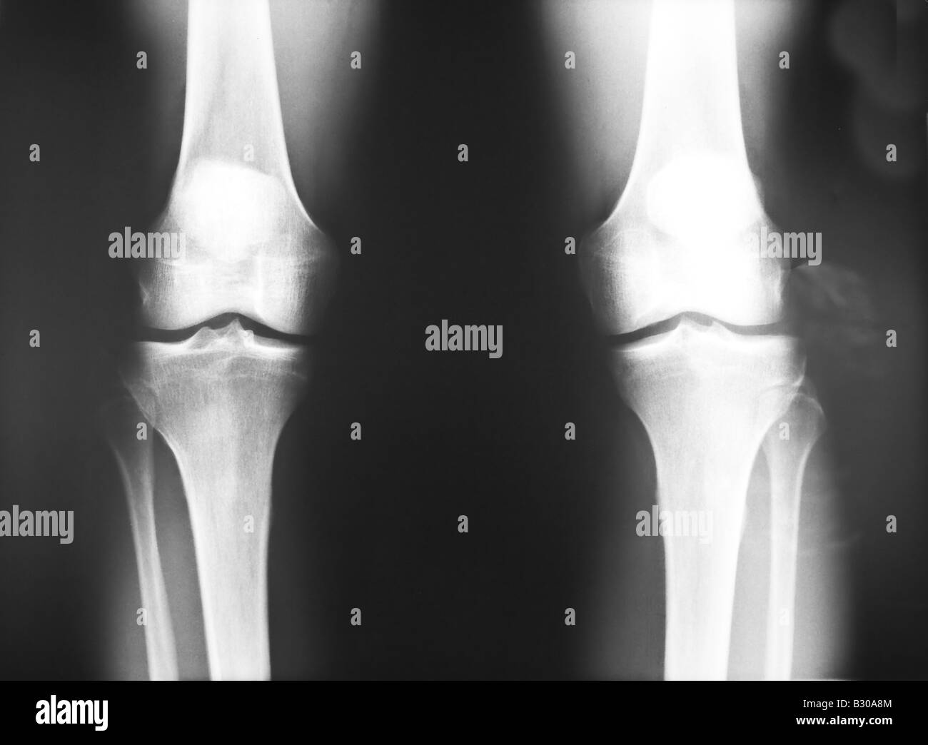 X ray of human knee joints Stock Photo - Alamy