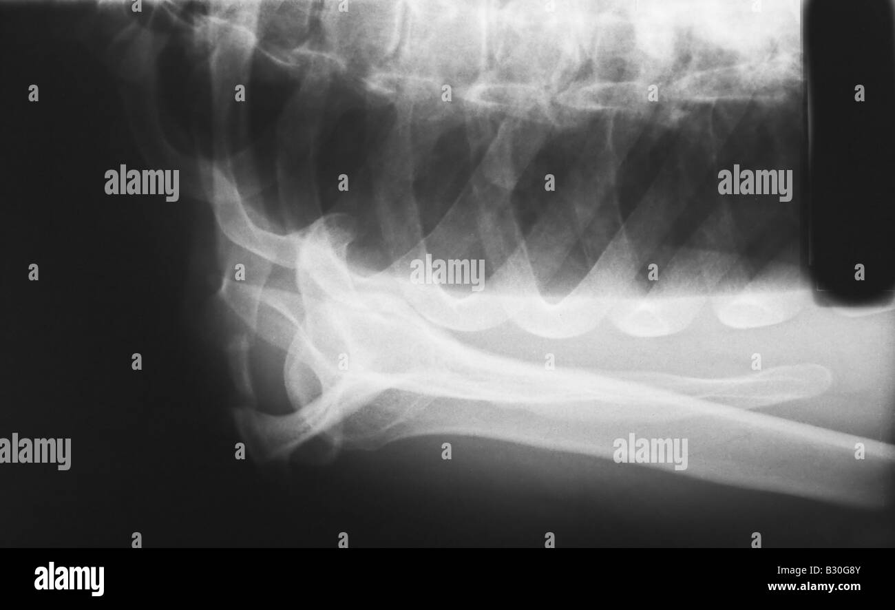 X ray of human shoulder Stock Photo - Alamy