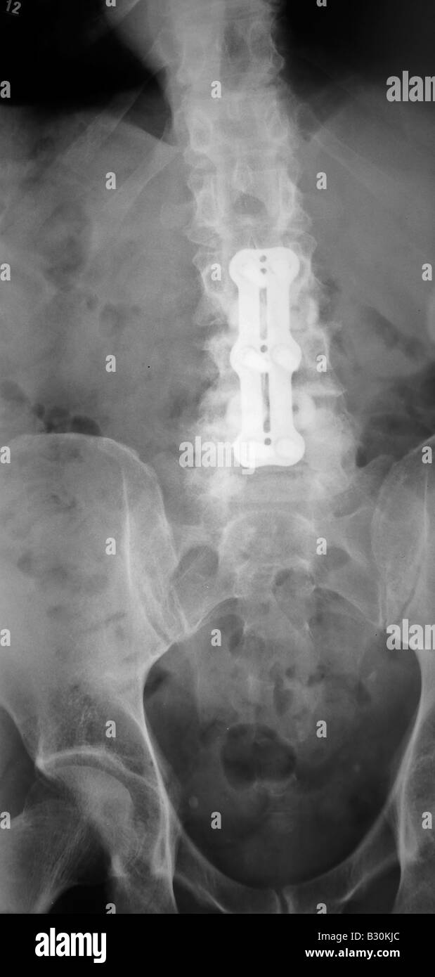X ray of human lumber spine showing hardware used in an Anterior lumbar ...