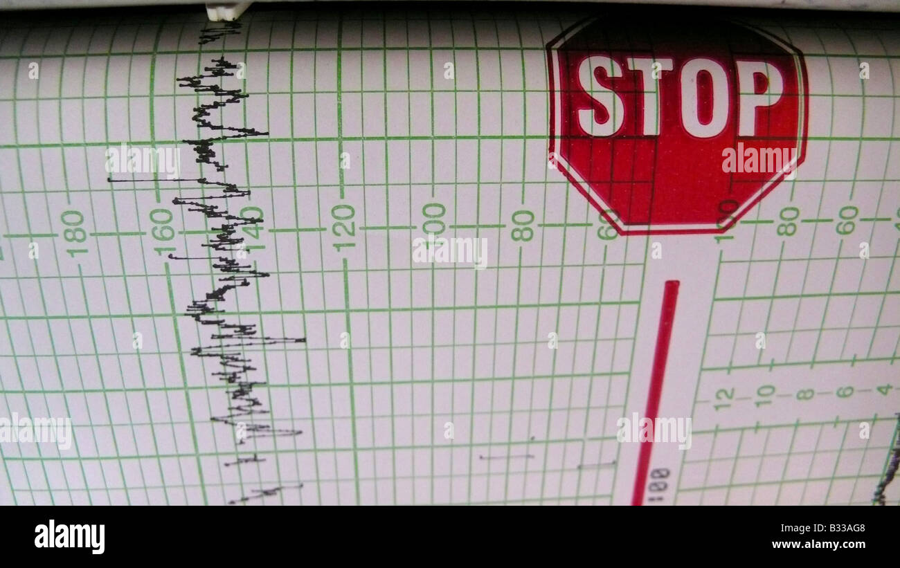 Cardiotocograph hi-res stock photography and images - Alamy