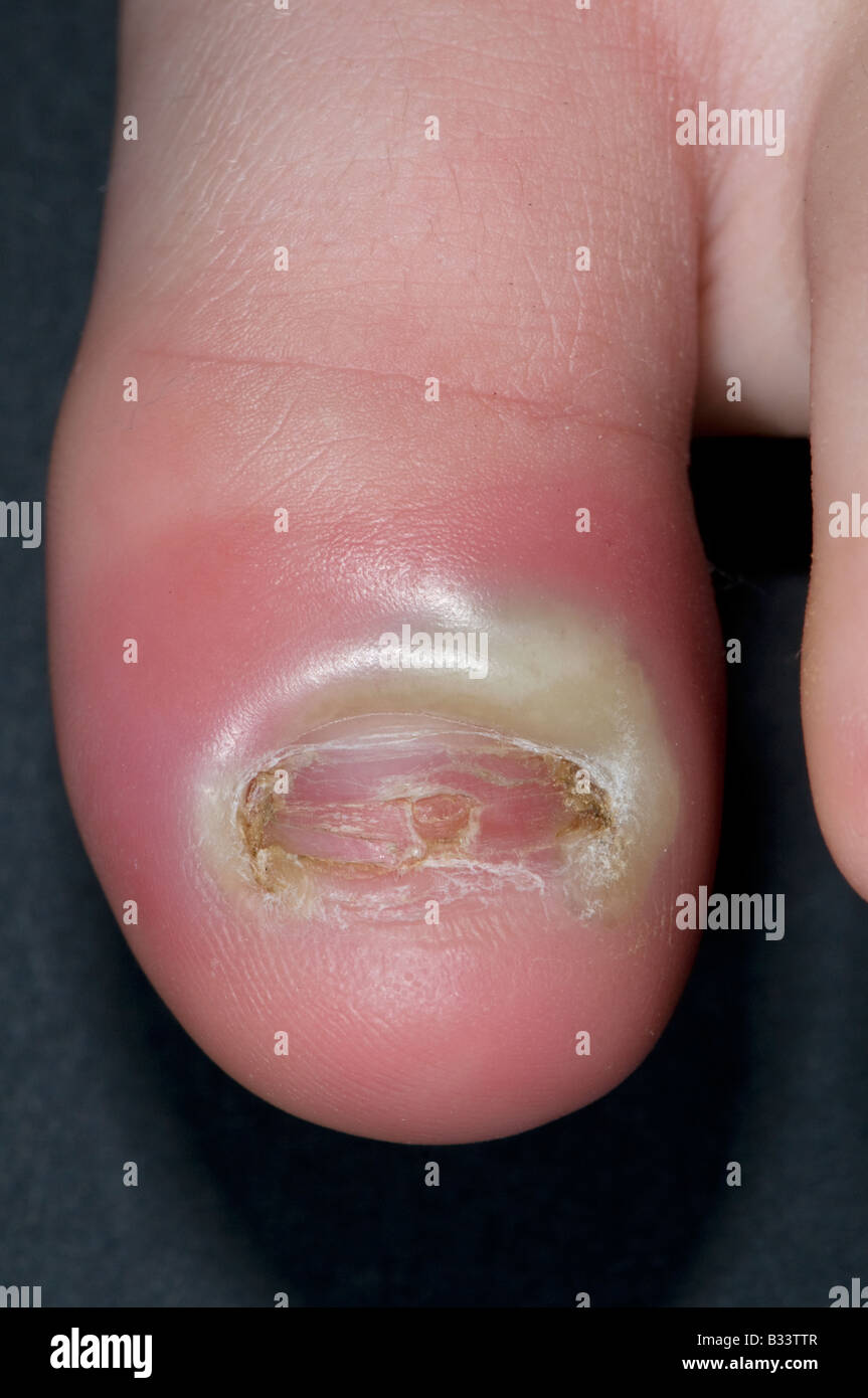 Abscess hi-res stock photography and images - Alamy