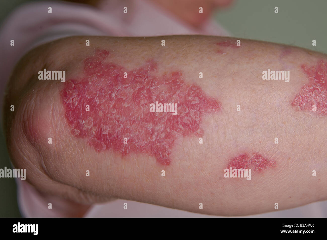 Psoriasis on hi-res stock photography and images - Alamy