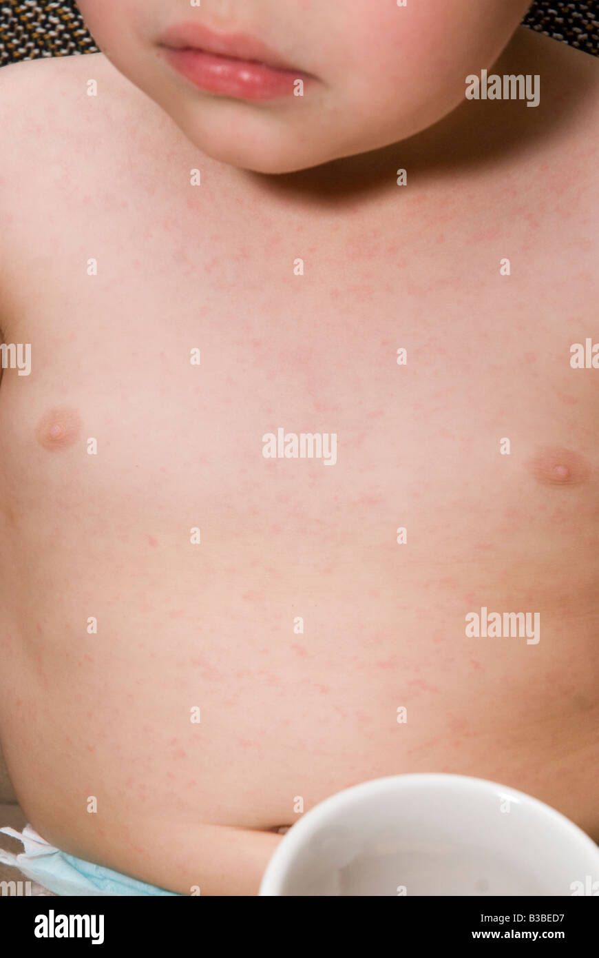 Sickly Child High Resolution Stock Photography and Images - Alamy