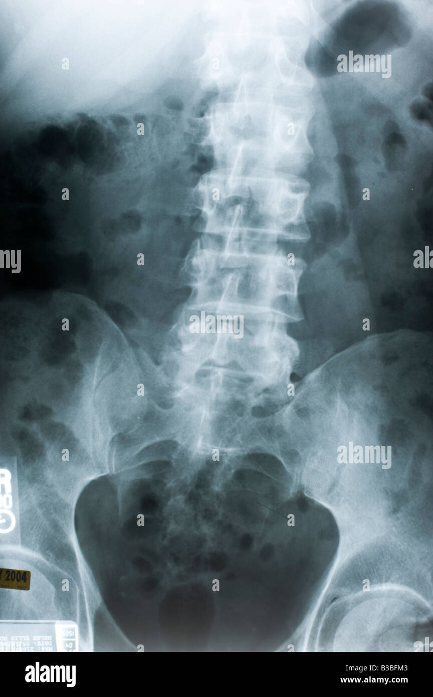 x-ray human male spine Stock Photo - Alamy
