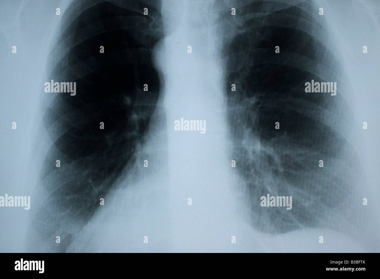 Male chest x ray hi-res stock photography and images - Alamy