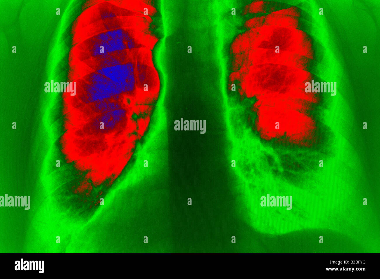 colored coded chest x-ray male Stock Photo - Alamy