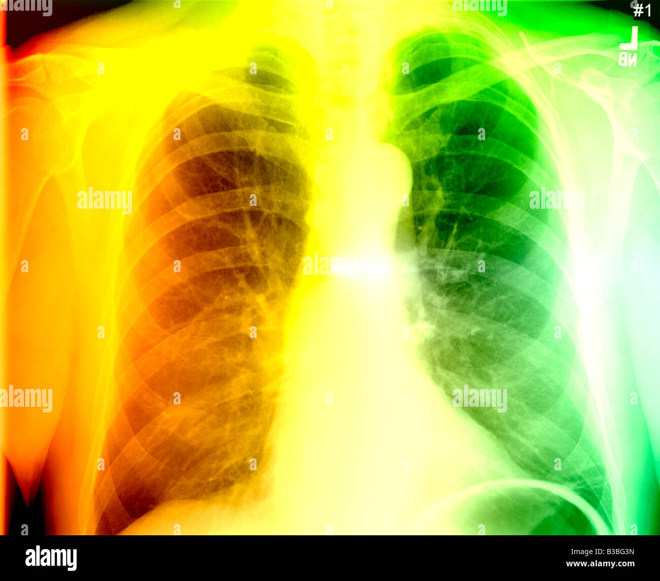 colored coded chest x-ray male Stock Photo - Alamy