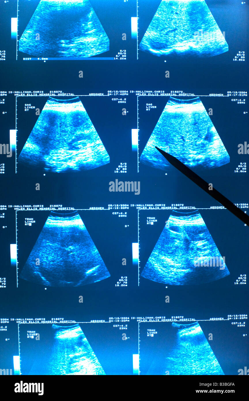 ultrasound of female chest Stock Photo - Alamy